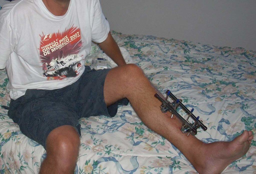 $325,000 Settlement for Pedestrian Hit by Car in Miami (Broken Leg)